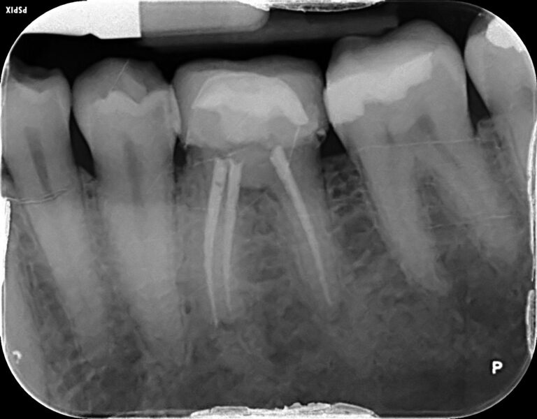ENDODONCIA CONSERVADORA - CENTRO PERIODONTAL DE VALENCIA